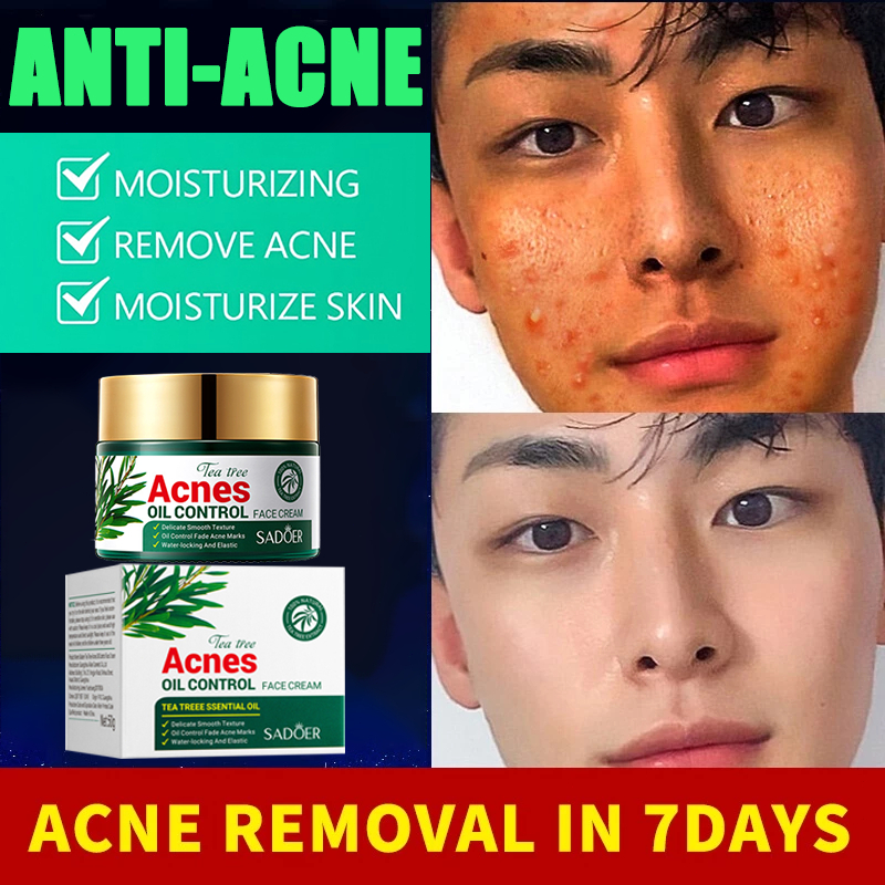 100% Effective Quickly Remove Pimples Fades Acne Marks Suitable For ...
