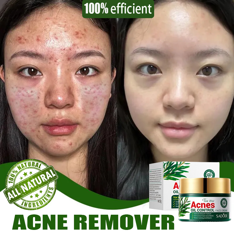 Pimple Remover Cream For Face Fast Acne Treatment Acting Pimple Removal ...