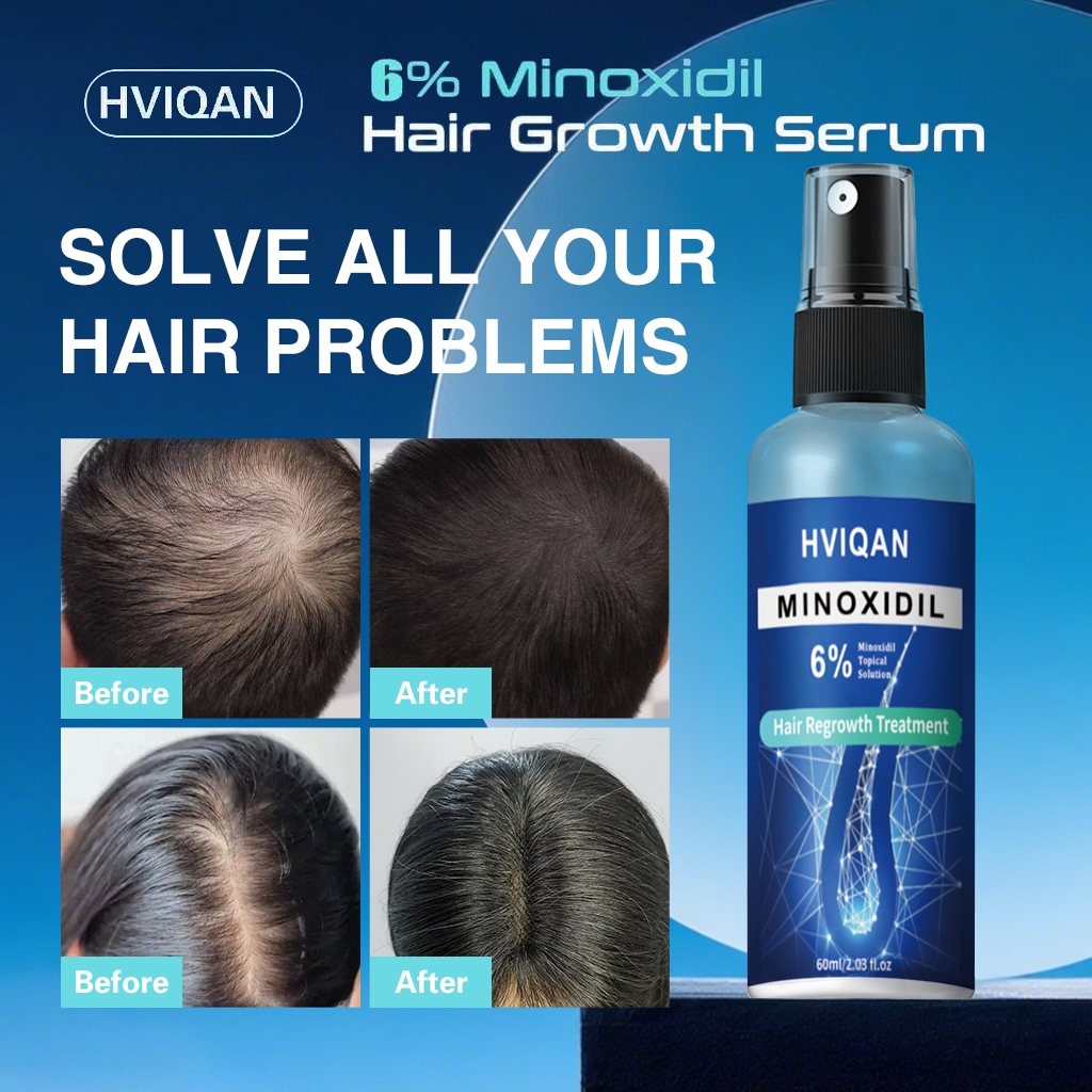 Minoxidil 6% Hair Growth Serum Fast Hair Growth Minoxidil Hair Grower ...