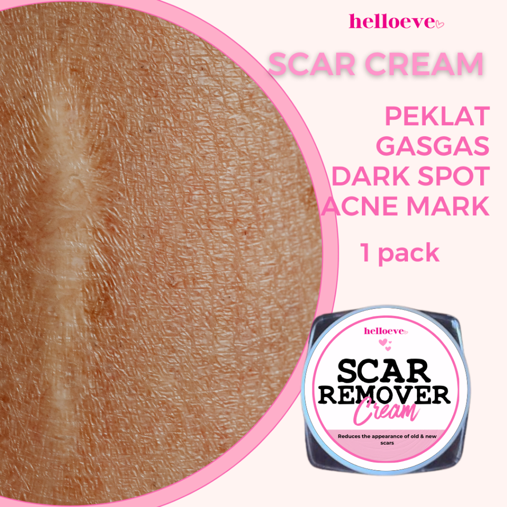 Scar Remover Cream for Peklat & Gasgas by Helloeve 5g | Shopee Philippines