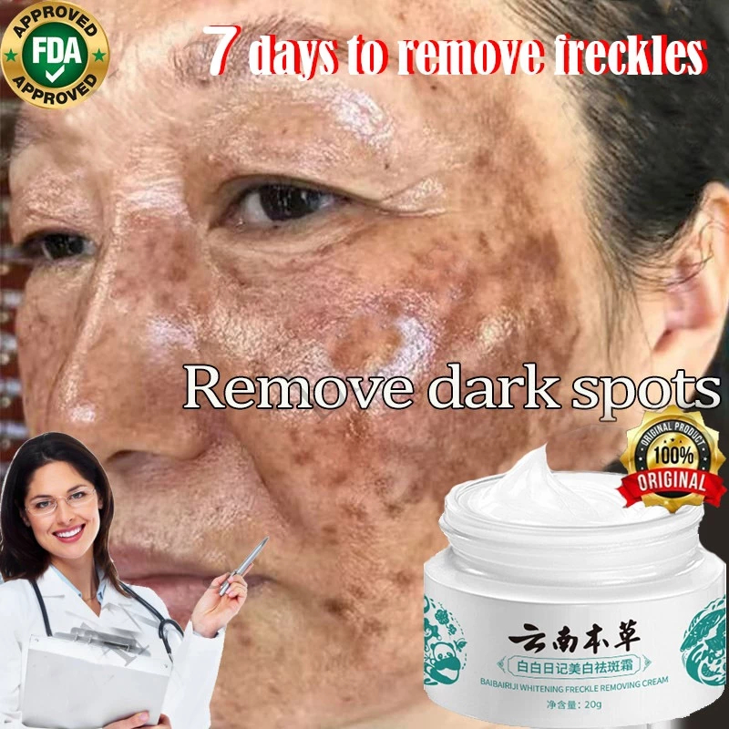 japanese melasma cream pekas remover Freckle cream melasma remover ...