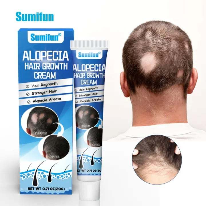 Alopecia Hair Growth Cream Pampakapal ng Buhok | Bald Spot, Hair Fall ...