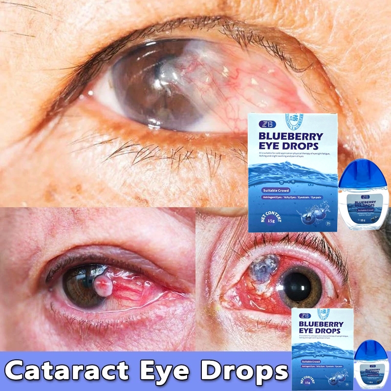 Blueberry eye drops original Cataract Dry eyes Pterygium Itchy eyes ...