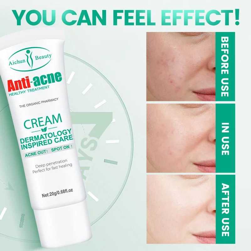 Anti- Acne Cream Treatment Pimple Marks Eraser Skin Repair Scar Removal ...