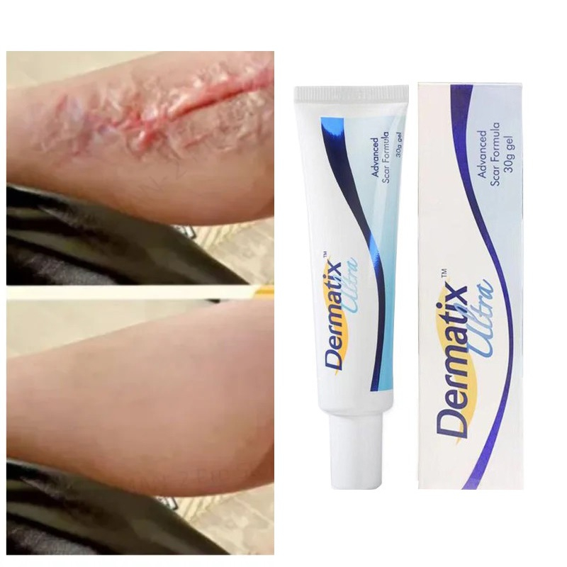 Dermatix Scar Remover Contractubex Scar Gel Original Magic Scar Remover ...