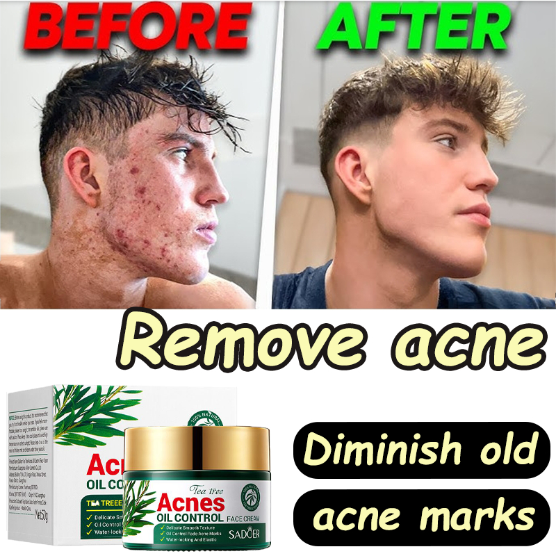 acne marks gel removal Let you no longer suffer from acne and pimples ...