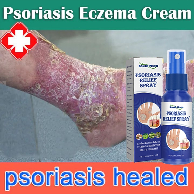 Skin Soothing Treatment psoriasis Soothing Spray Itchy dry skin rash ...