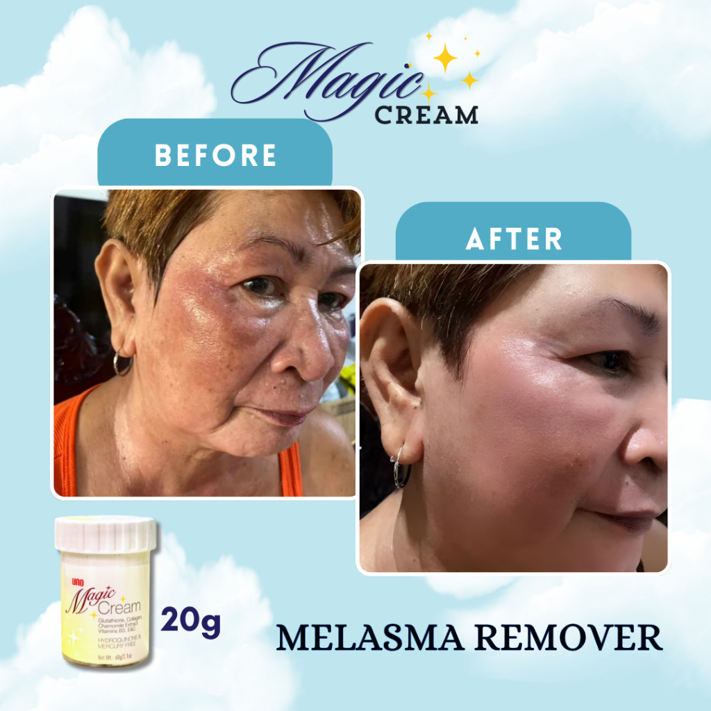 UNO Magic Cream Pampawala ng Pekas, Melasma & Scar Remover w ...