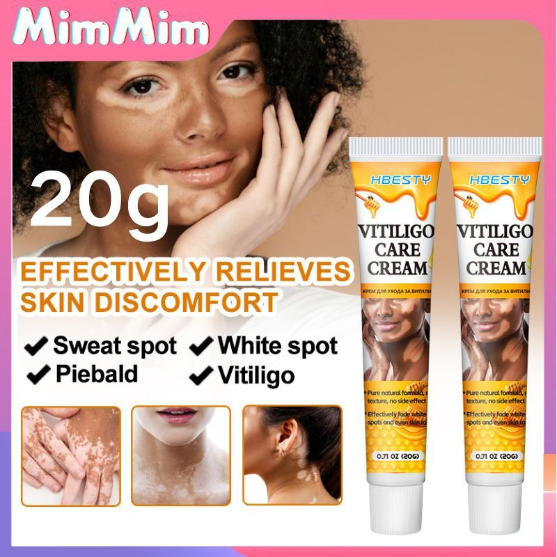 Vitiligo Cream Vitiligo Treatment Cream White Spots Tag / Kulugo ...