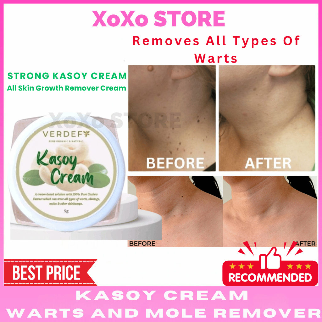 Kulugo Remover Original Kasoy Cream – Fast Acting Warts, Skin Tags, and ...