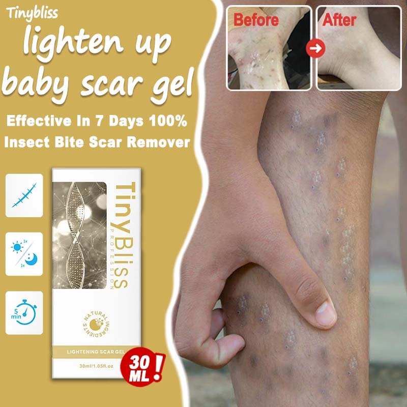 TinyBliss Lighten Up Lightening Baby Scar Gel 30ML insect bite Scar ...