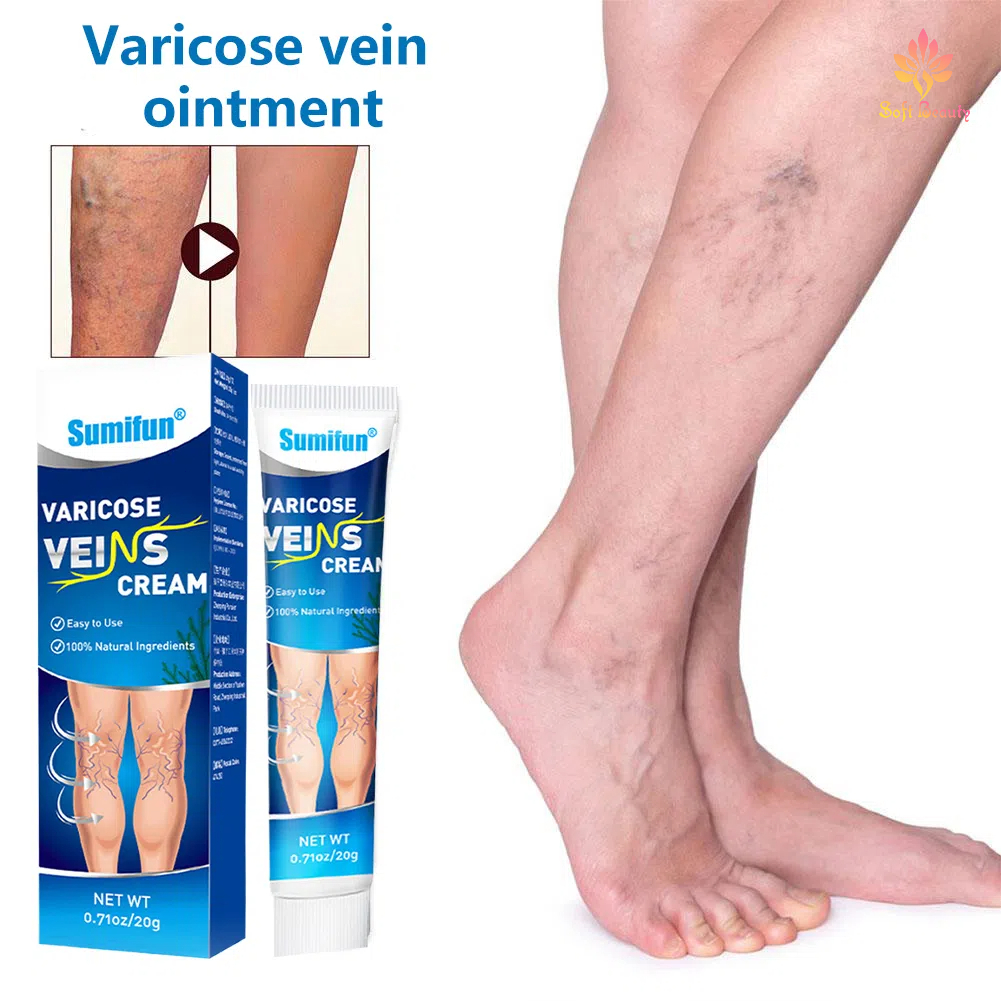 Varicose Vein Remover Spider Vein Treatment Cream Varicosity Legs ...