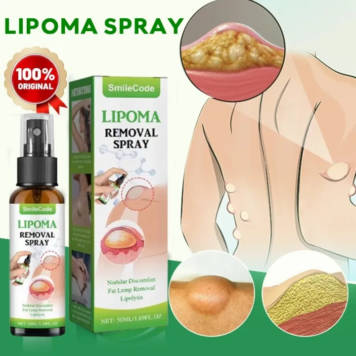 Lipoma Removal Spray Lipolysis Fat Lump Relief Plaster Skin Swelling ...