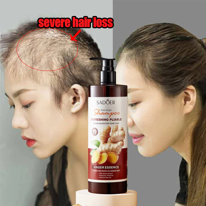 Ginger shampoo Hair grower Hair growth Anti dandruff shampoo 500ml Anti ...