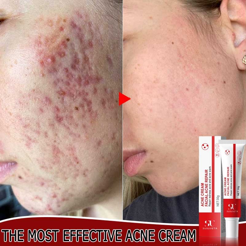 Acne cream anti acne acne remover pimple remover acne treatment pimple ...