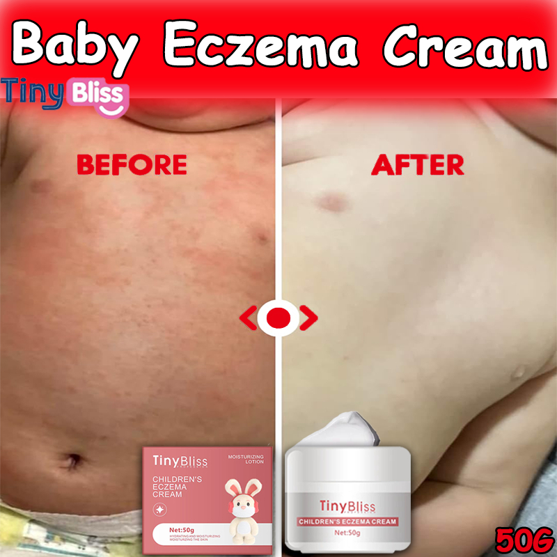 TinyBliss Baby Eczema Cream 50g Rash Diaper Rash Cream Antiseptic Baby ...