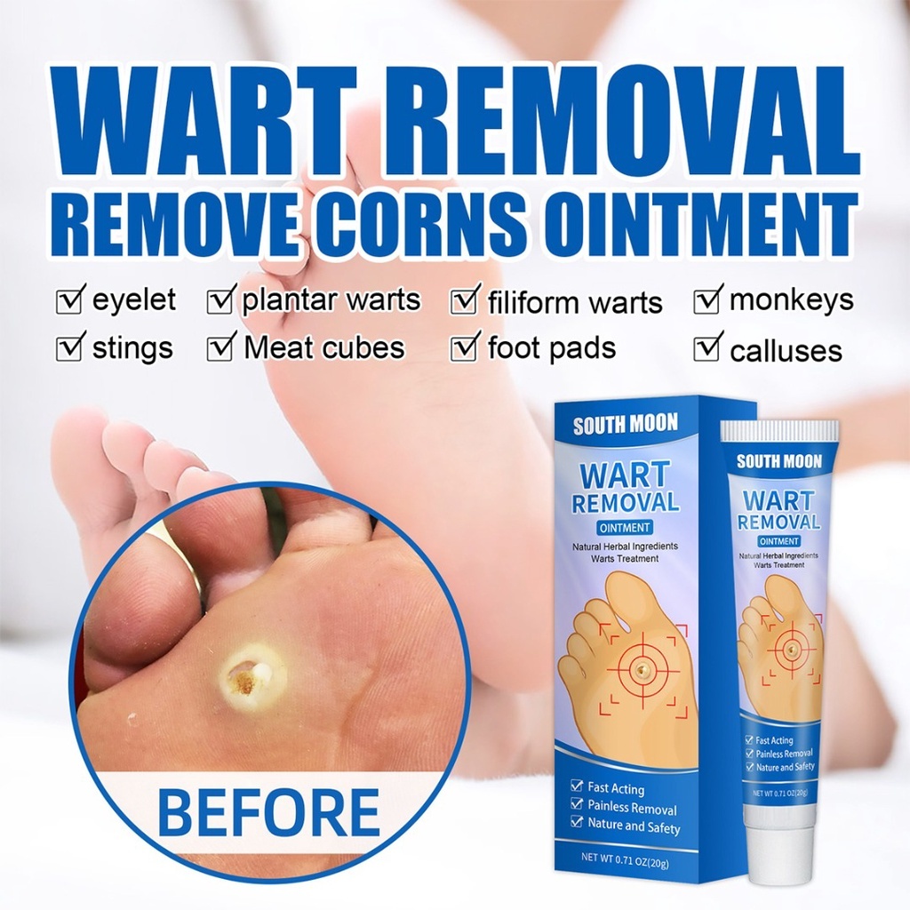 Wart and Mole Remover Cream Natural Extract Corn Plaster Warts Ointment ...