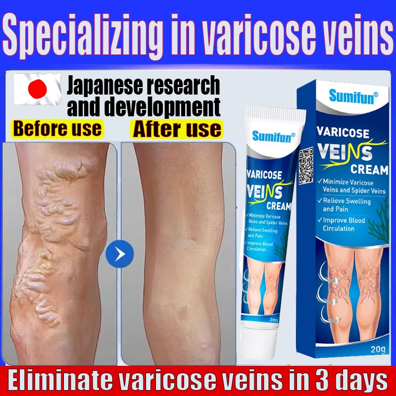Varicose vein removal cream that effectively treats vasculitis,quickly ...