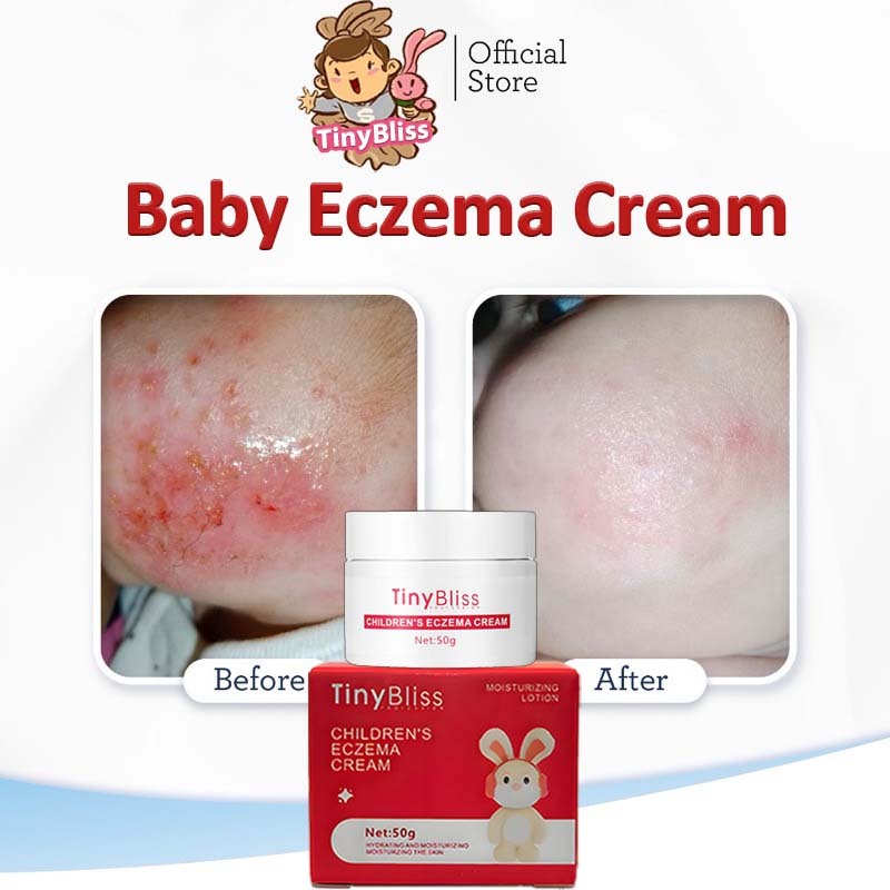 TinyBliss Rash Cream For Baby Itch Relief Antiseptic Baby Eczema Cream ...