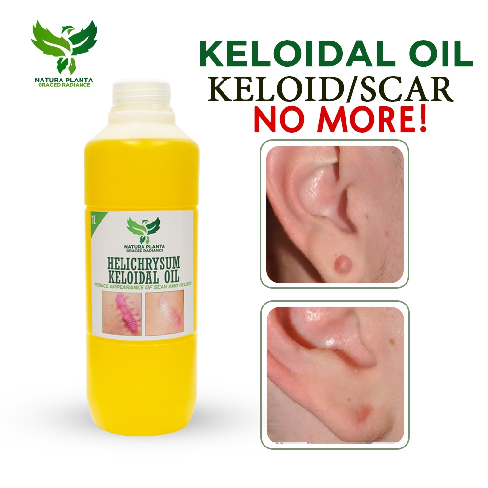 Helichrysum Keloidal Oil | Pampawala ng Peklat at Keloid | Anti ...