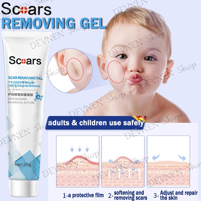 Scar Removal Cream Acne Scar Remover Remove Scar Kelloid Stretch Mark ...