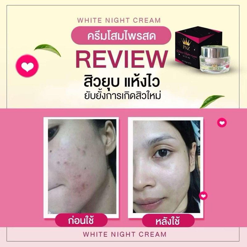 PNZ NIGHT CREAM FOR PIMPLES,BLEMISHES,AND MELASMA | Shopee Philippines