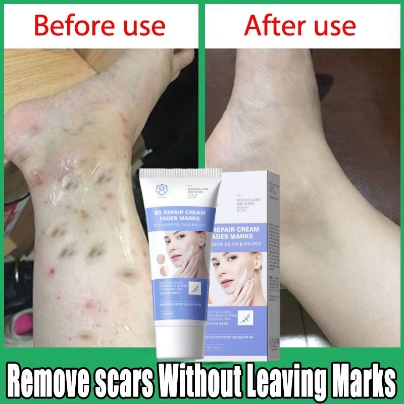 60g Original Scar Removal Cream Peklat Acne&Scar Remover Cream Scar ...