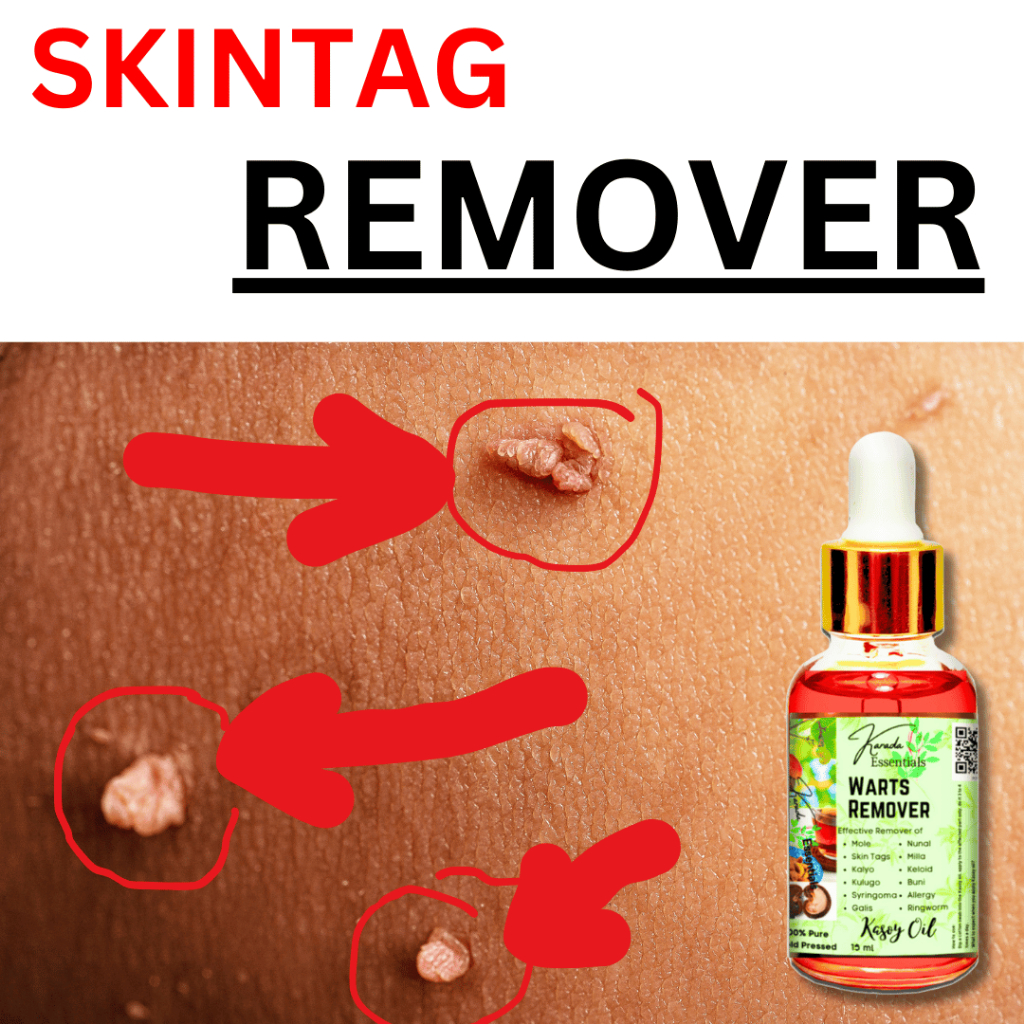 Organic Skin Tag & Wart Remover Kasoy Oil for Mole Nunal Kulugo ...