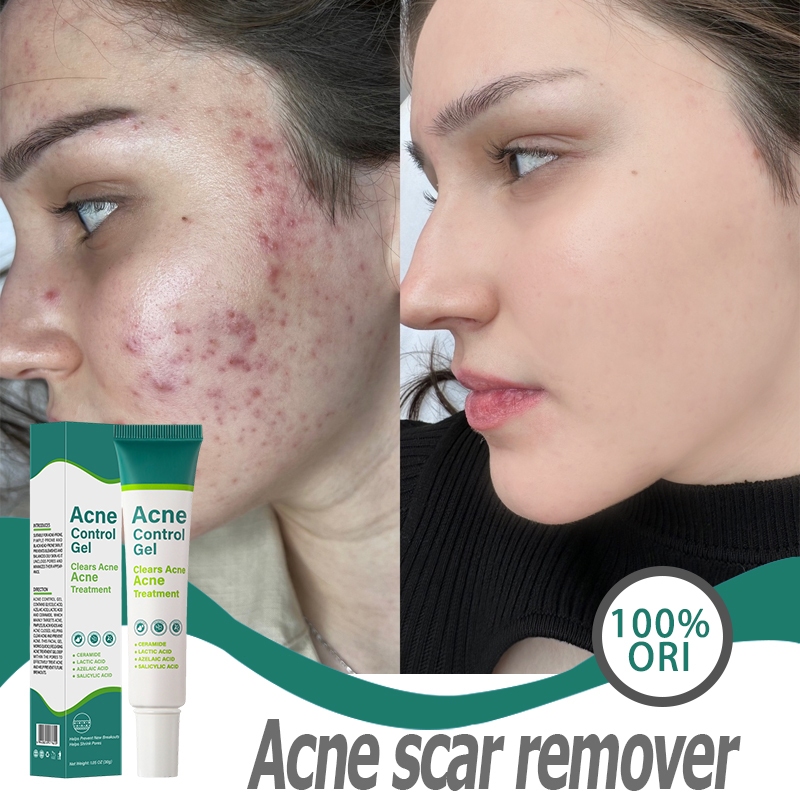 Acne spot treatment for acne permanent pimple marks remover acne scar ...
