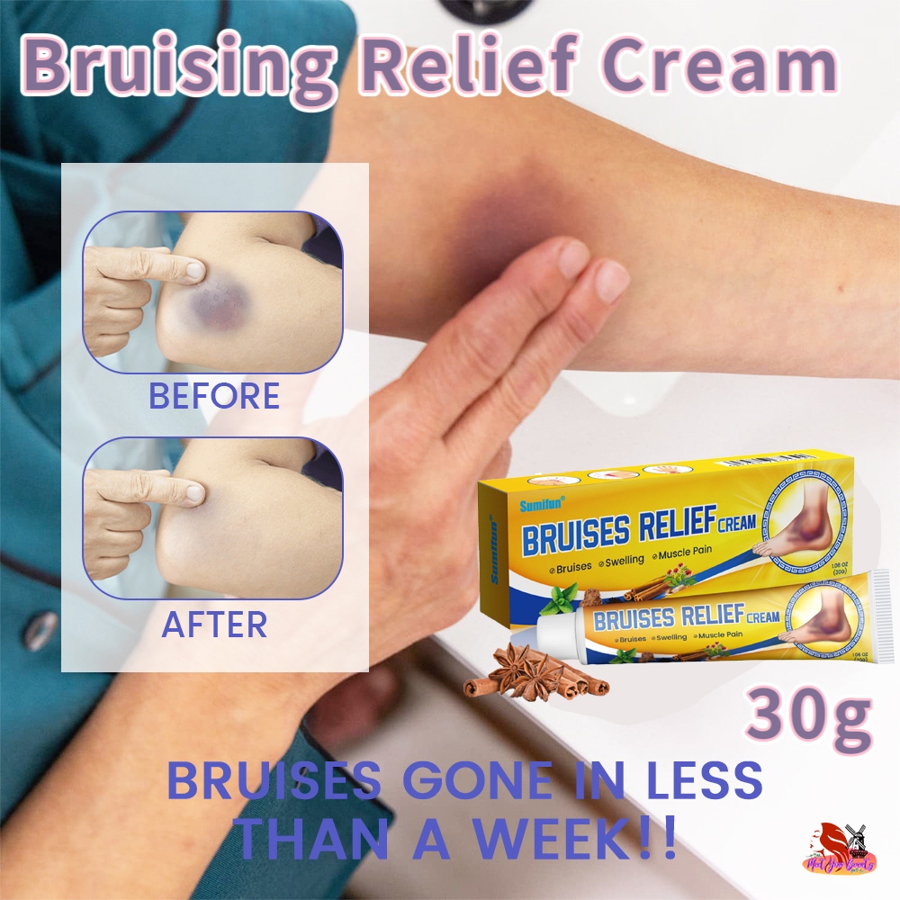 Bruising Treatment Cream Bruises Injury Swelling Pain Relief Cure ...