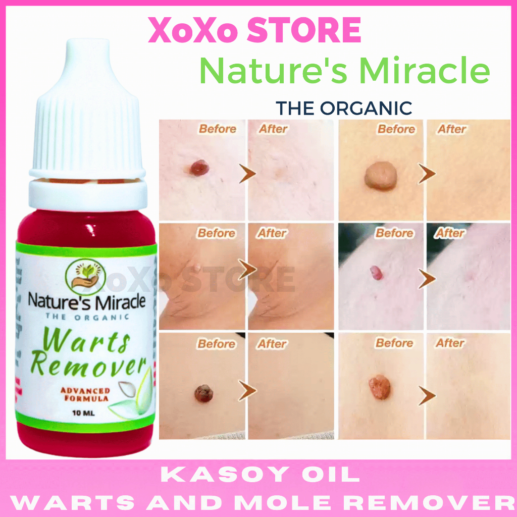 Original Kasoy Oil Wart Removal – Nature’s Miracle Warts & Kulugo ...
