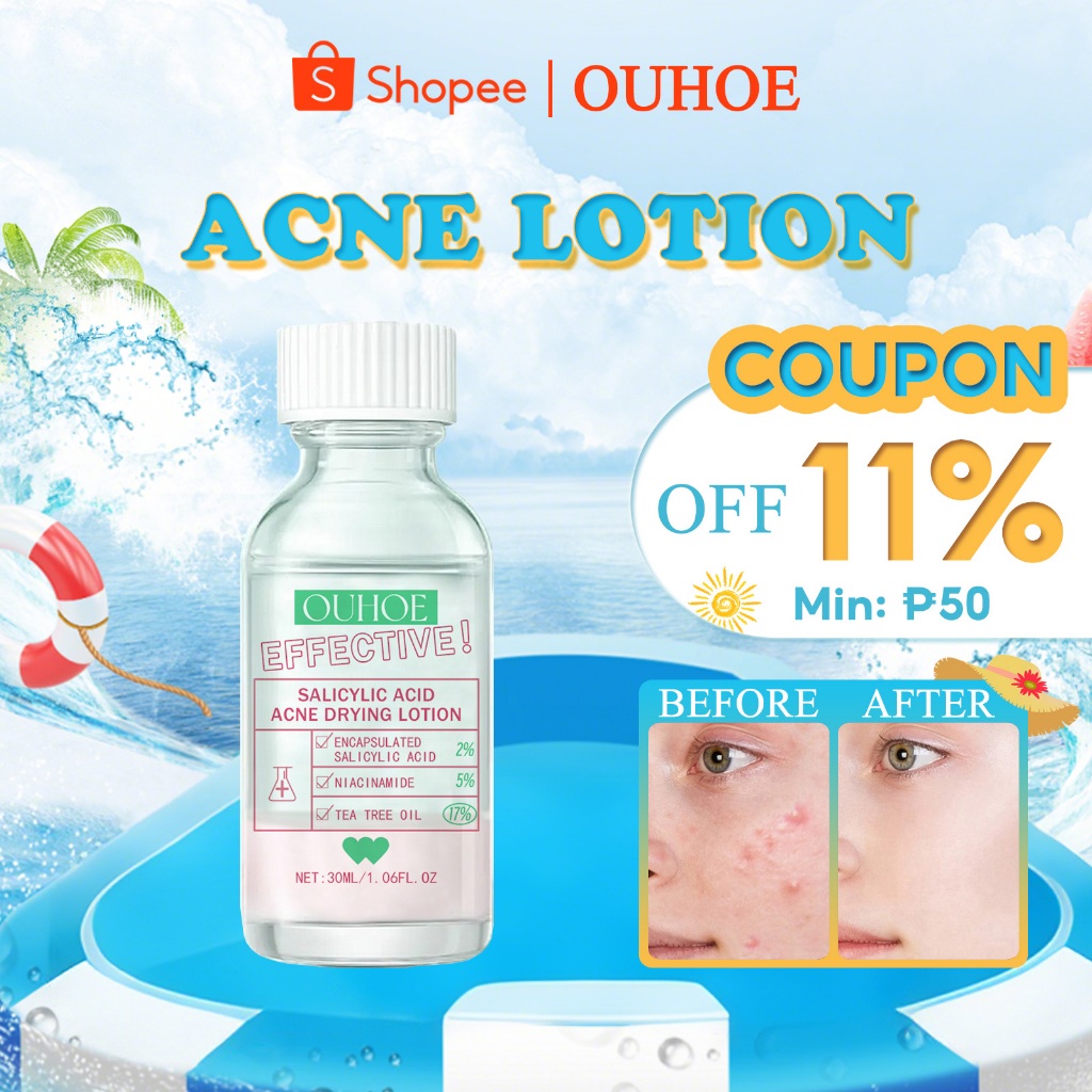 OUHOE Salicylic Acid Acne Drying Lotion 30ml Pimple Warrior Salicylic ...
