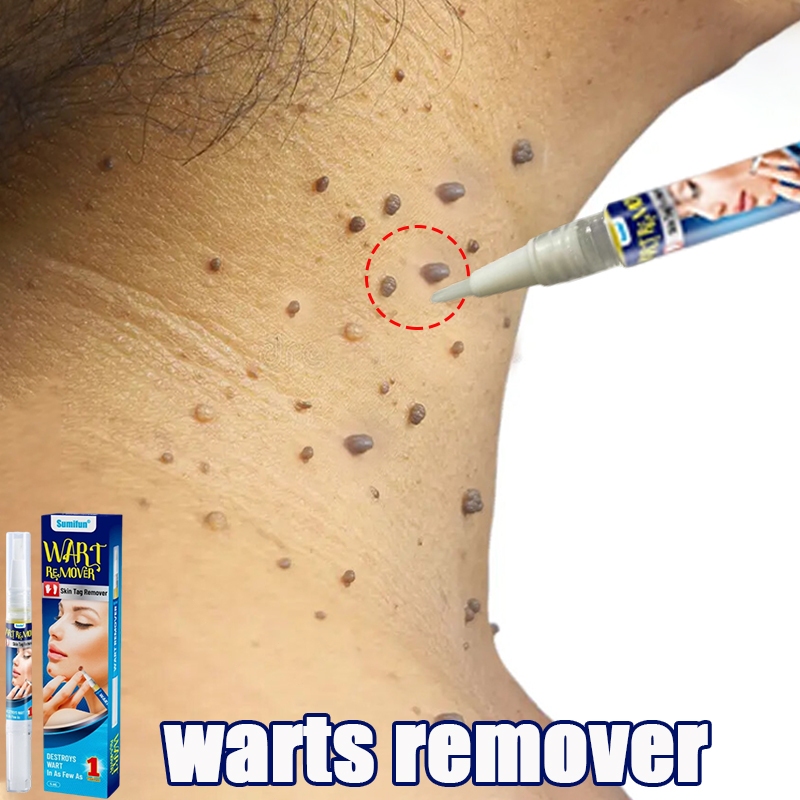 Wart remover 15days painless effective elimination warts and skin tag ...