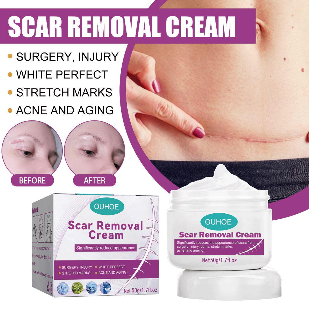 SWEETRIP Old Scar Remover Cream Stretch Marks Repair Gel Peklat Remover ...