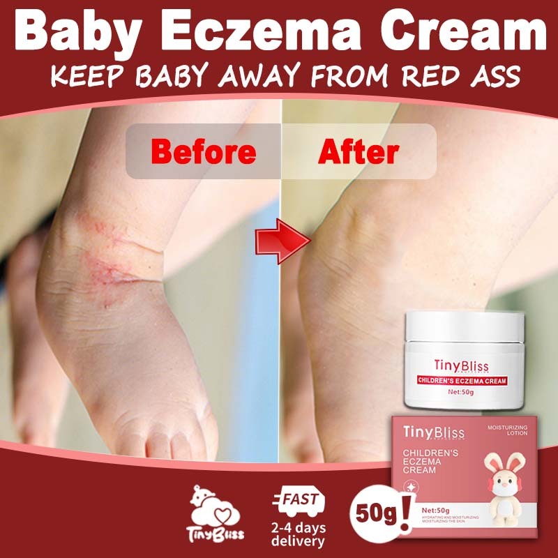 TinyBliss Eczema Cream For Kids 50g Baby Rashes Cream acne skin care ...