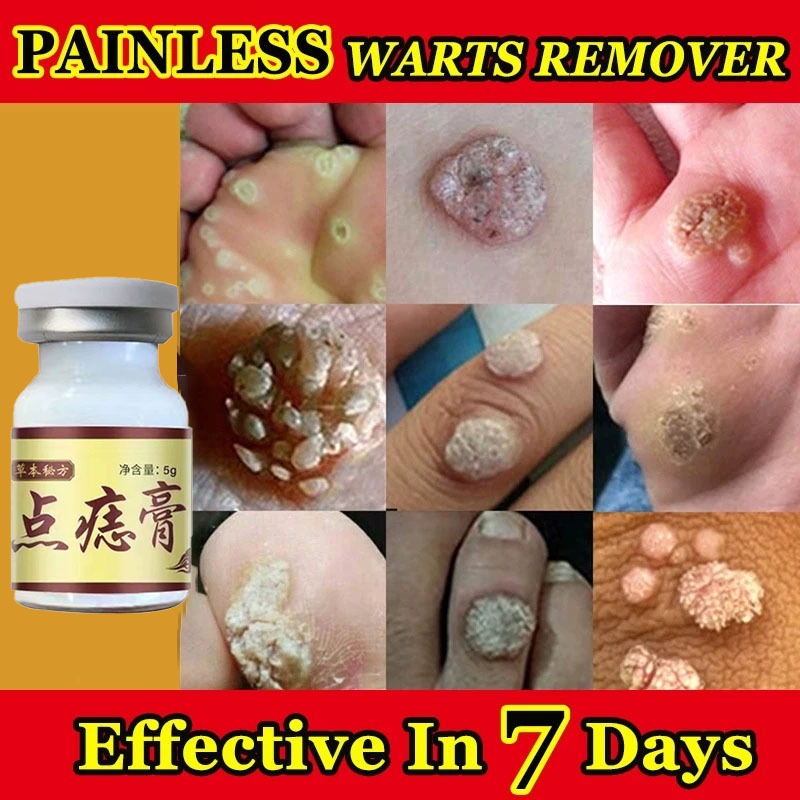 Concentrated Potent Skin Removal Cream Body Warts Cream Spot Mole ...