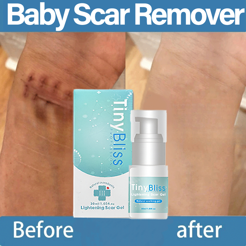 TinyBliss Lighten Up Lightening Baby Scar Gel Baby Scar Remover Peklat ...