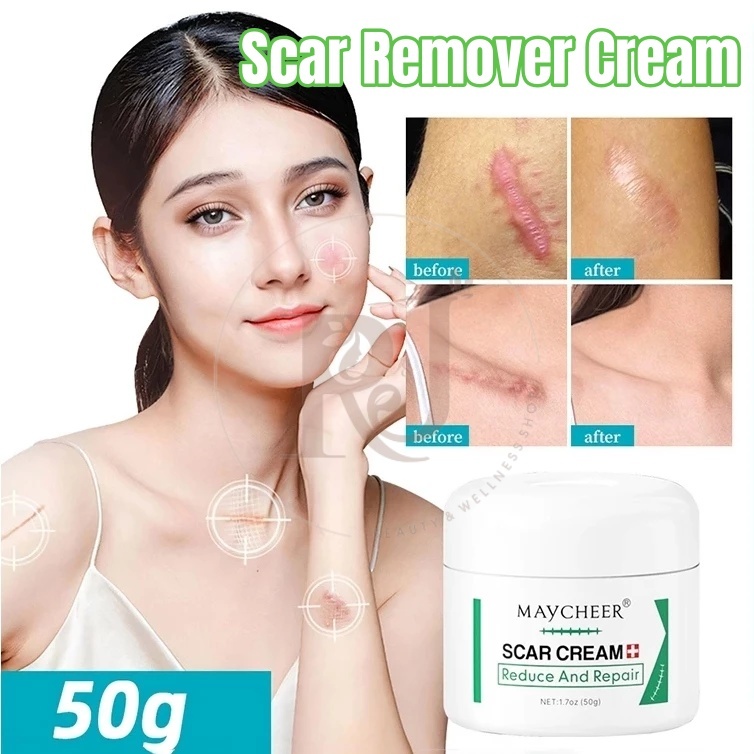 Scar Removal Cream Peklat Remover Acne Treatment Remover Old Scar ...