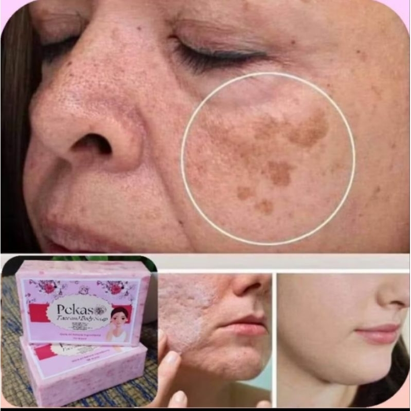 100% LEGIT PEKAS SOAP & PEKAS REMOVER CREAM | Shopee Philippines