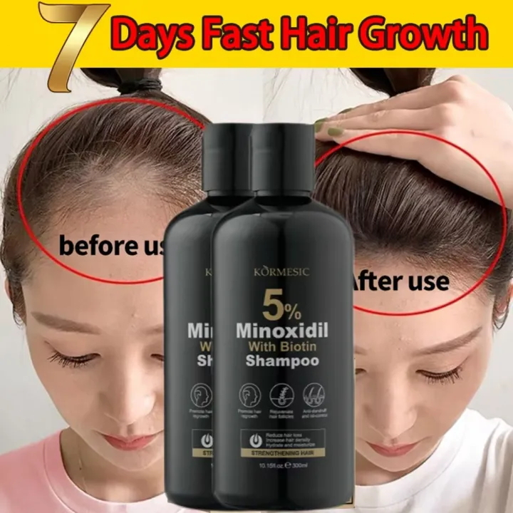 Minoxidil 5% With Biotin Hair Grower Shampoo 300ml Original For Hair ...