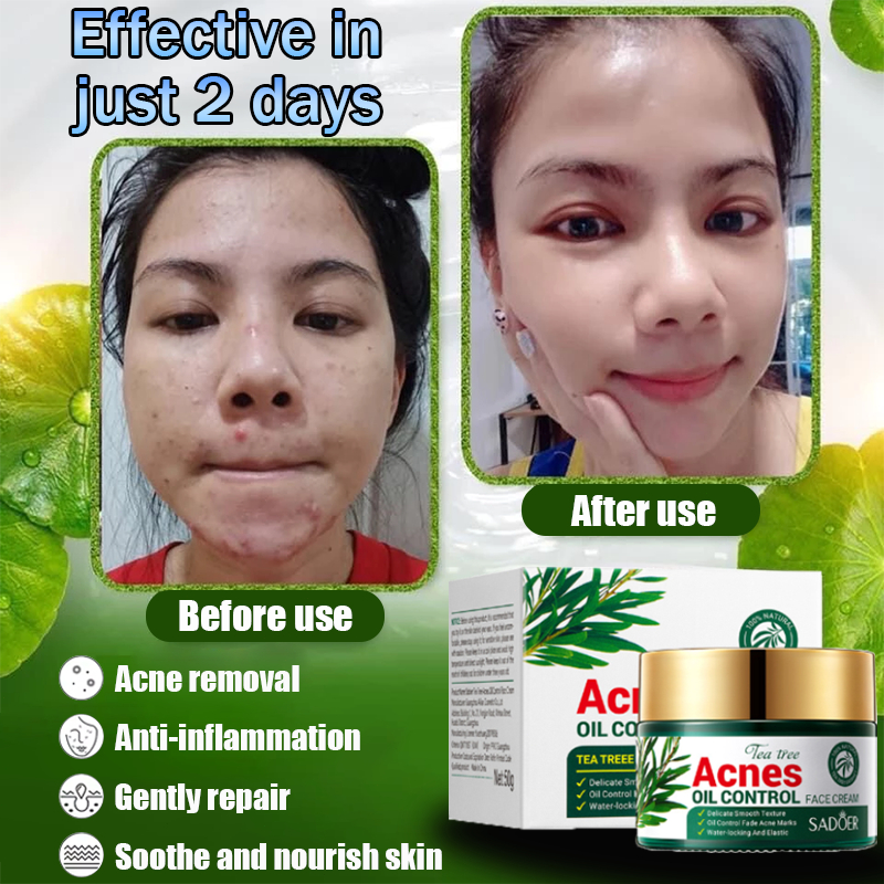Pimple remover 100% Effective Quickly Remove Fades Acne Marks Suitable ...