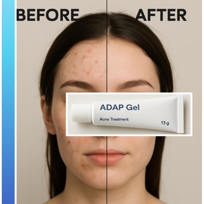ADAP .1% / .3% Gel - Acne damage and pigmentation reducer / MdiLines ...
