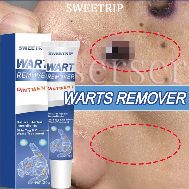 Warts Removal Cream Painless Genital Wart Remover Against Condyloma ...
