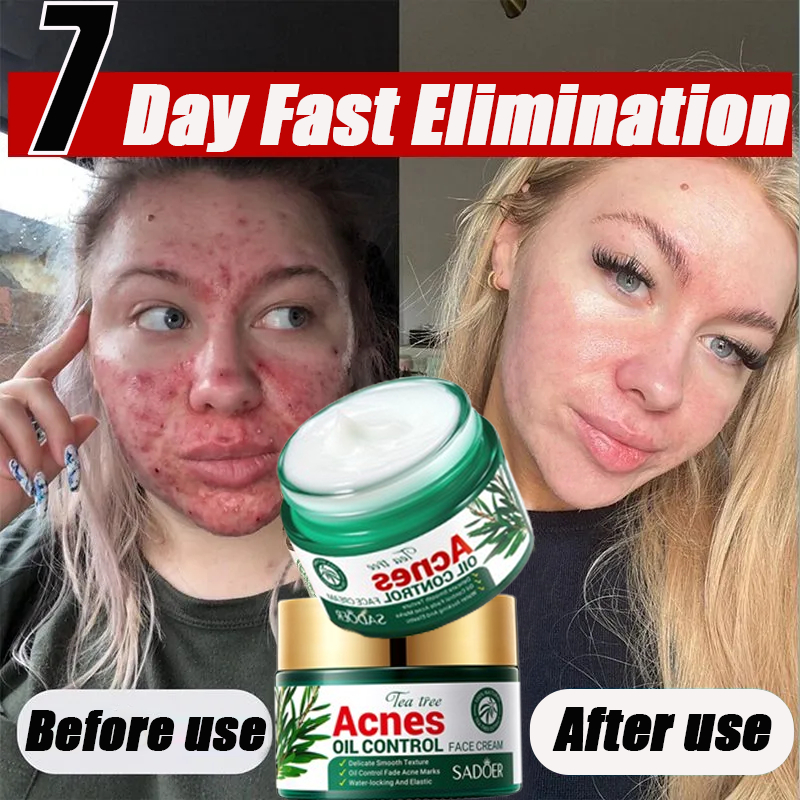 Pimple Marks Remover Skin Care Repair Comedone Whitening Pimple Remover ...