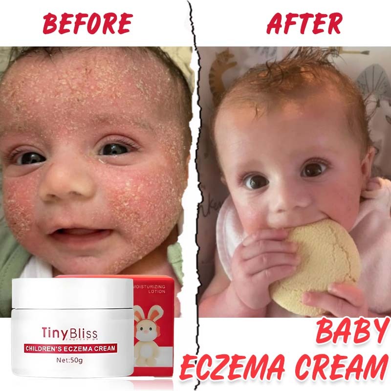 Tiny bliss baby rashes treatment 50g Itch Relief Antiseptic anti rashes ...