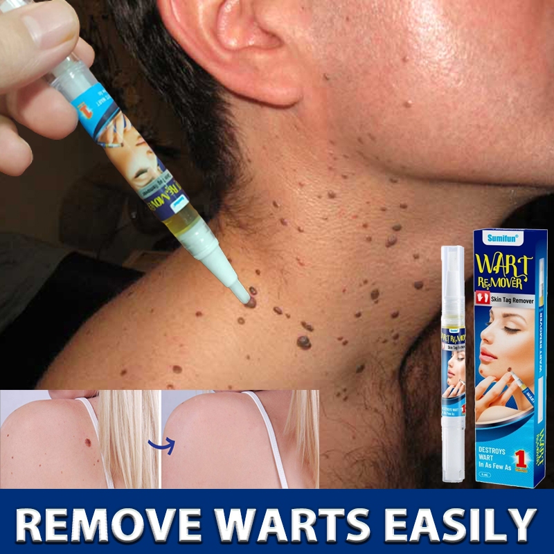 milia removal kulugo remover warts remover 4ml/1pcs warts removal cream ...