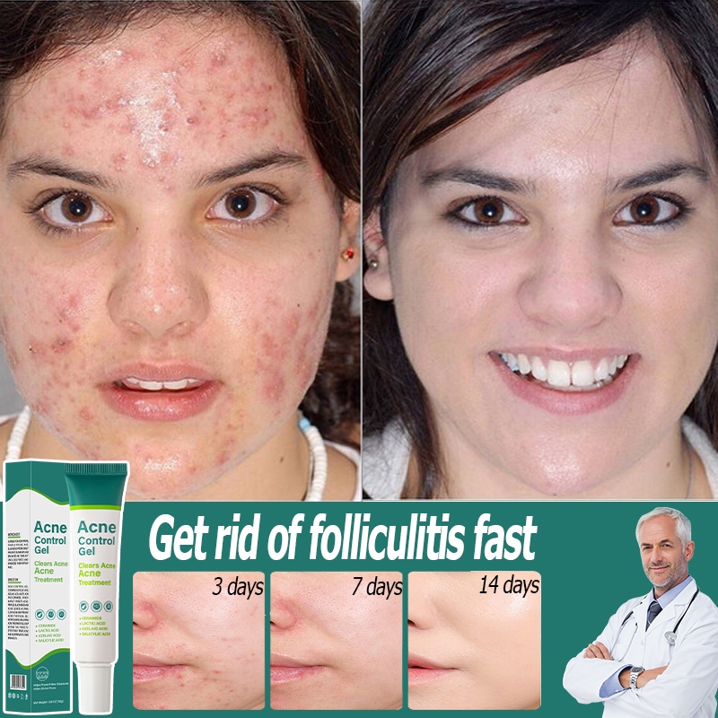 Acne spot treatment for acne permanent pimple marks remover acne scar ...