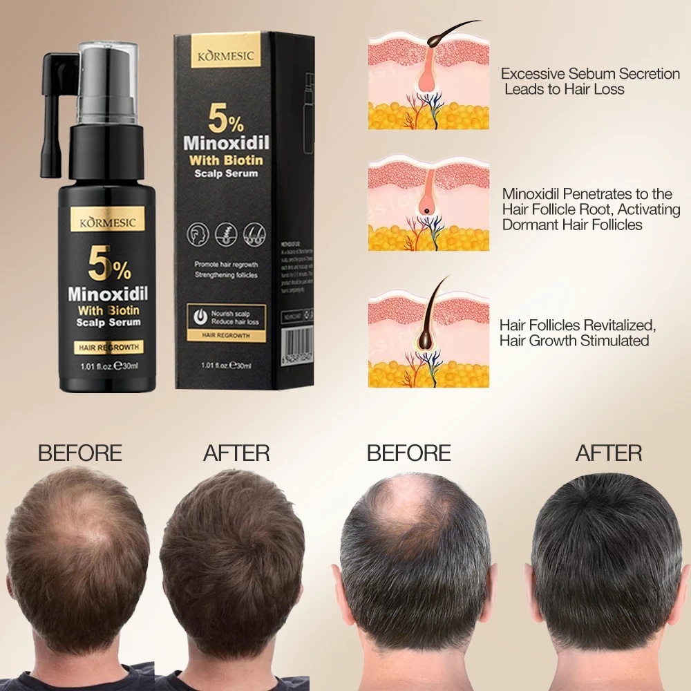 Minoxidil 5% Hair Grower Spray with Biotin 30ml Hair Loss Treatment for ...