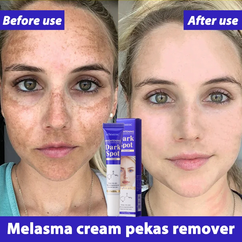 Cream for melasma dark spot remover melasma remover cream original ...