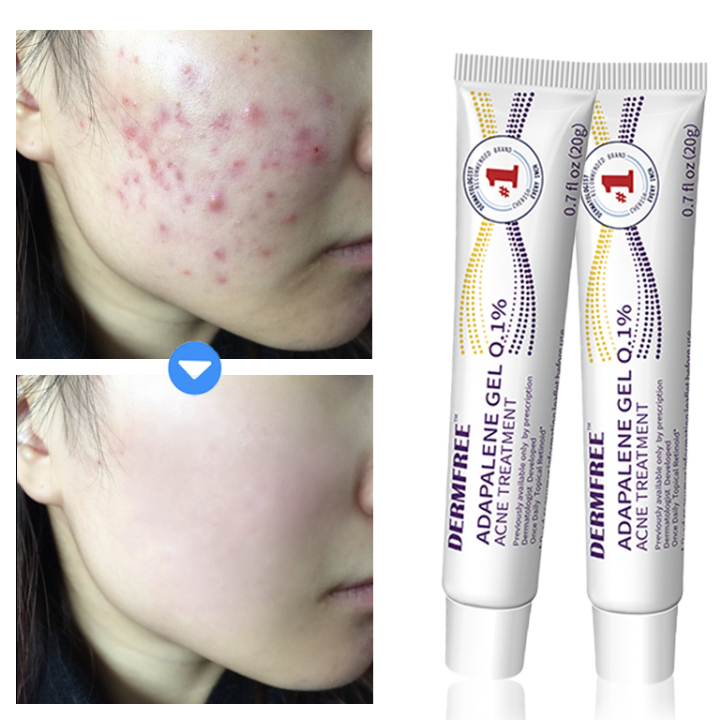 Dermfree Acne Remover Pimple Treatment Acne Cream Pimples Acne ...